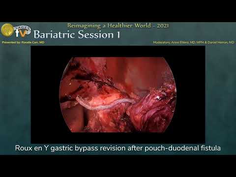 Roux en Y gastric bypass revision after pouch-duodenal fistula