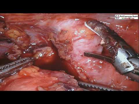 Robotic Roux-en-Y Hepaticojejunostomy in a Post-cholecystectomy Bile Duct Injury