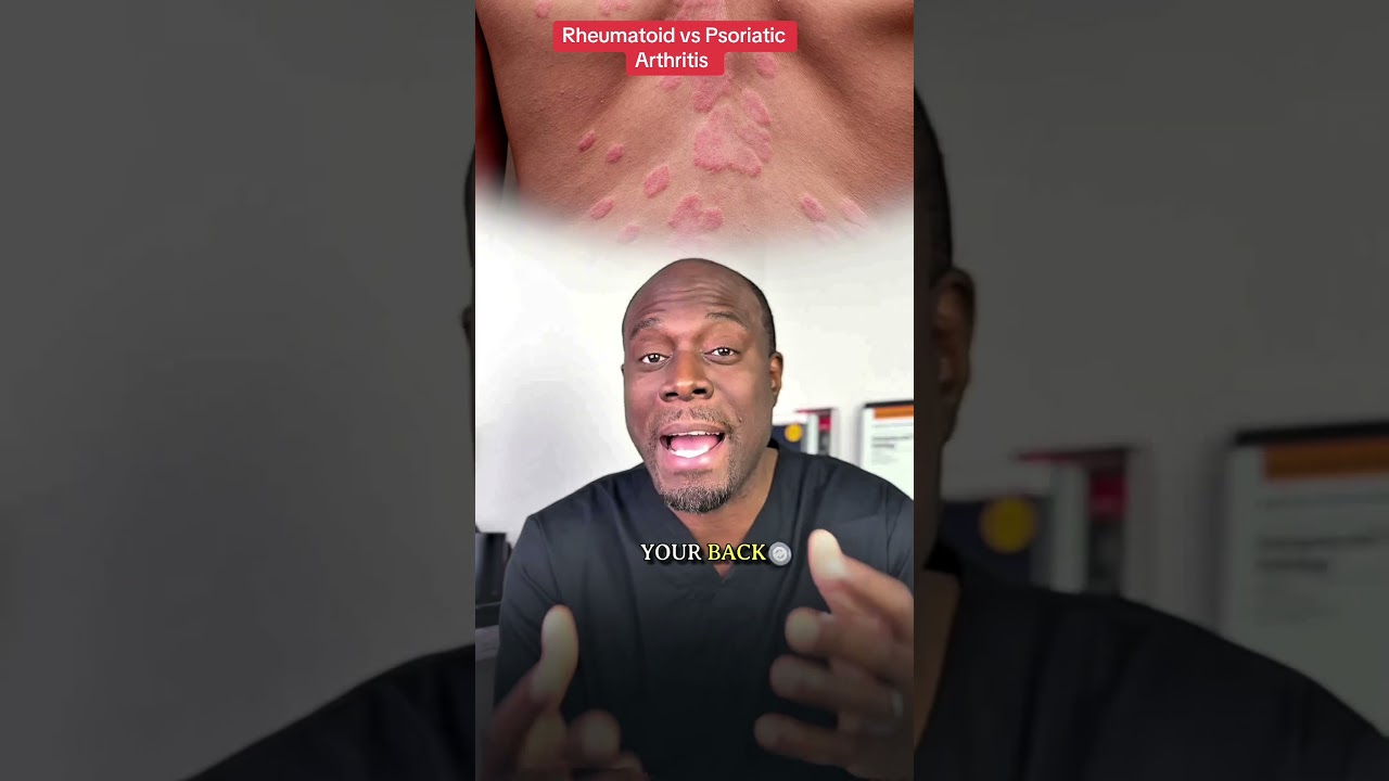 Rheumatoid vs Psoriatic Arthritis