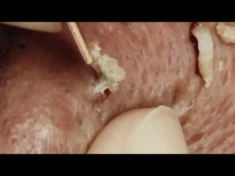 Healthy and beauty - how to remove blackheads Part 10