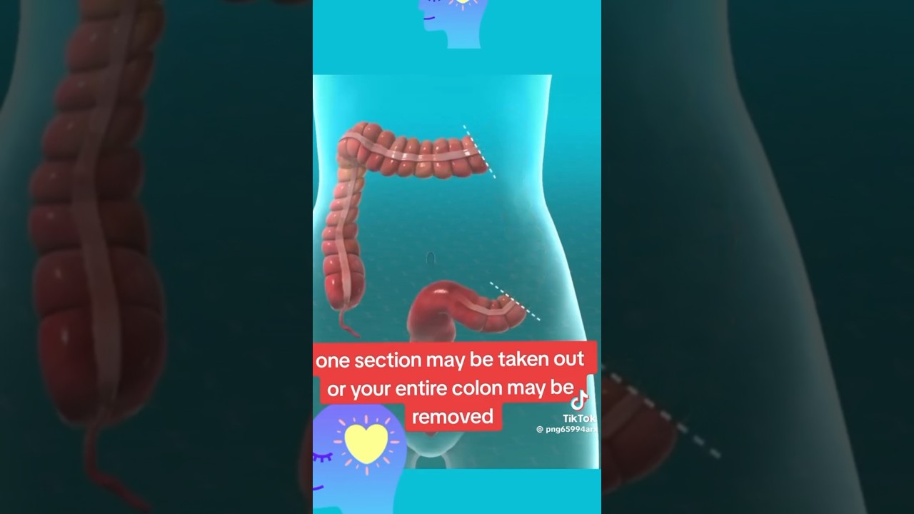 How a colectomy is performed