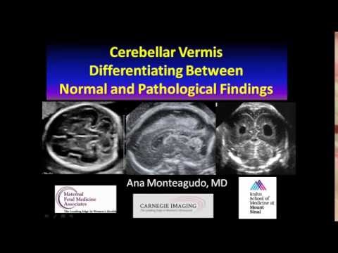 AIUM Webinar: Cerebellar Vermis