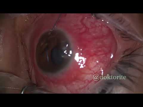 Juvinile Glaucoma GATT operation