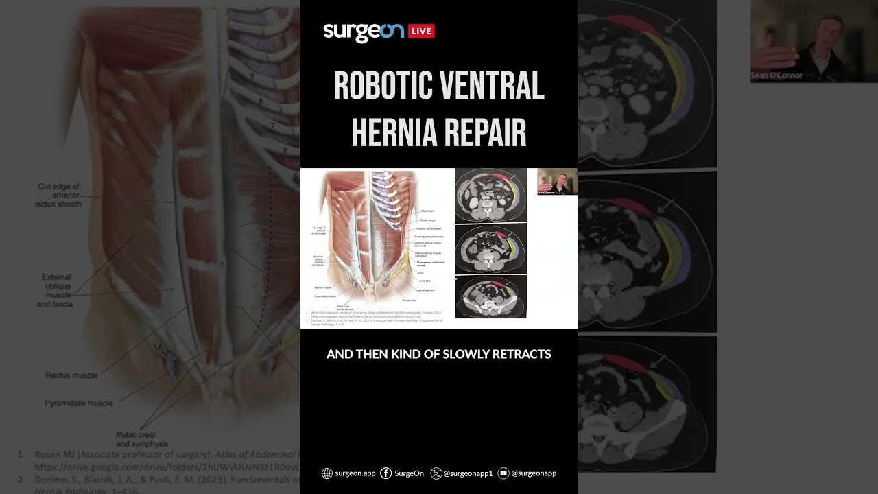 Navigating Complex Robotic Ventral Hernia Repai