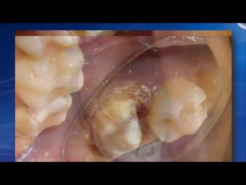 CO2 Laser Dentistry - Procedures & Benefits