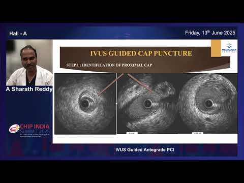IVUS-guided antegrade wiring of CTO - Live lecture by Dr. Sharath Reddy