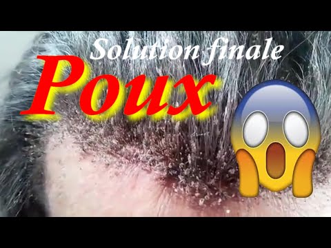 Tout sur les Les poux et et leur traitement