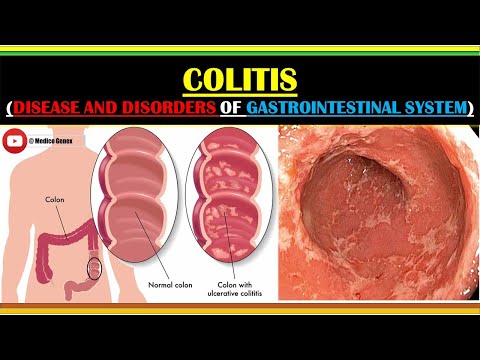 COLITIS | TYPES OF COLITIS | CAUSES OF COLITIS | PATHOPHYSIOLOGY OF COLITIS | MANAGEMENT OF COLITIS