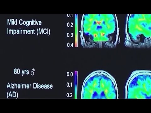 New Alzheimer's drug, donanemab, to be approved by FDA end of this year
