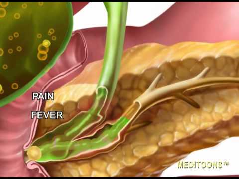 Gallstone Pancreatitis (Gallstone) - Meditoons™
