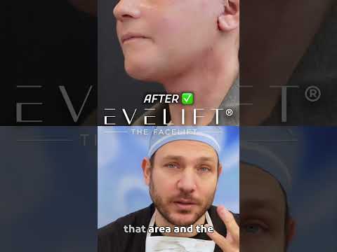 EVE Lift™ To ReStructure The Neck And Redefine The Jawline | Dr. Ali Charafeddine, MD | Miami, FL