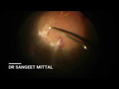 Around the Table Dissection in Proliferative Diabetic Retinopathy with Tractional Retinal Detachment