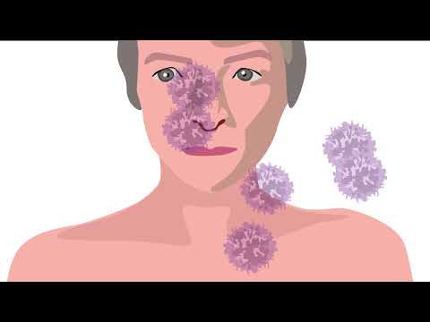 What is follicular lymphoma?