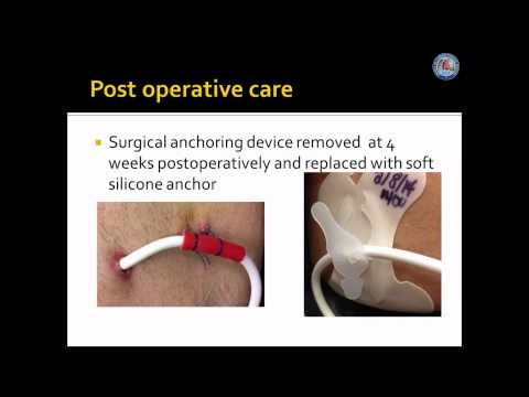 [Keynote Lecture] Technique for minimizing and treating driveline infections