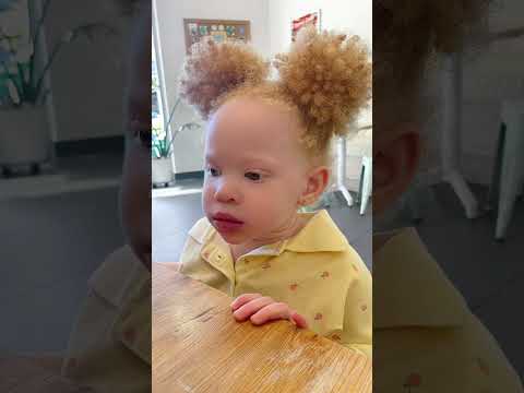 What type of #albinism does Zayana have? #albinismawareness #albinismisbeautiful #albino