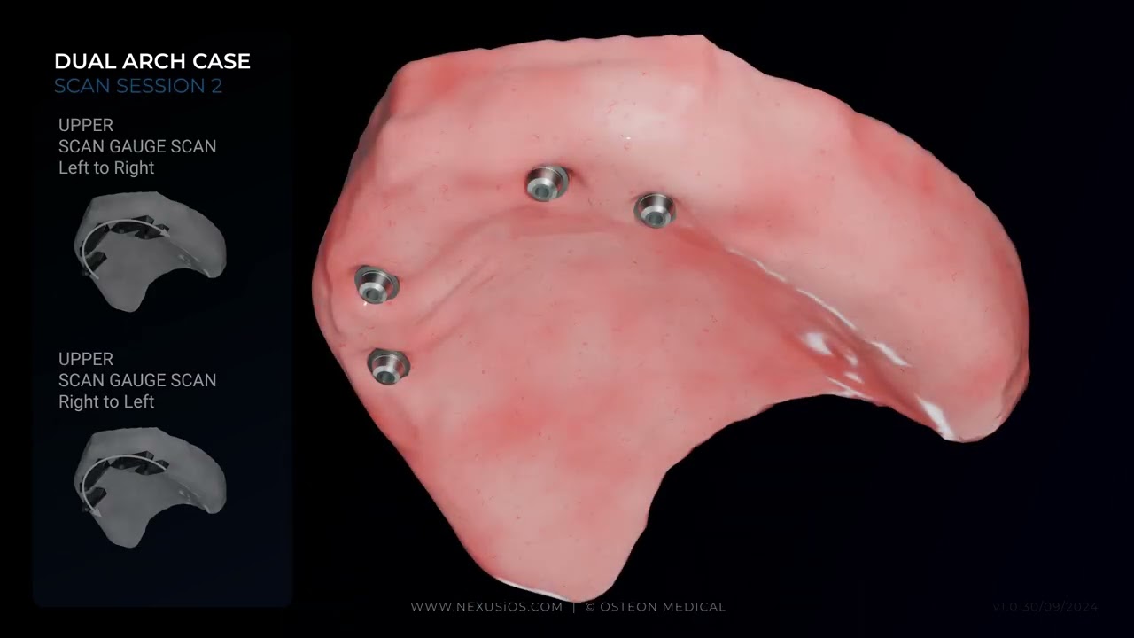 Nexus iOS - Definitive Protocol from Denture - Dual Arches