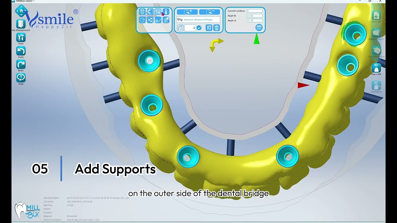 All on X Setup Process | Digital Dentistry