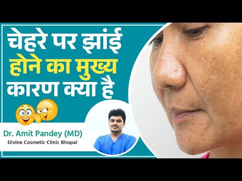 चेहरे पर झाई होने का कारण क्या है || Dr amit pandey || #beauty #hair #like #skincare
