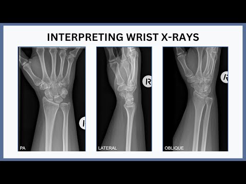 Interpreting Wrist X-Rays