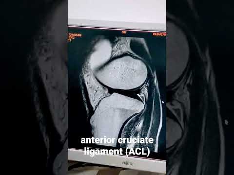 MRI KNEE ACL sag #mri #anatomy #mri #medicalstudent #paramedical #radiology