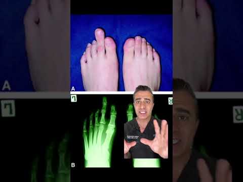 Dr. K talks about Abnormal Large toe
