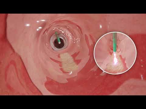ArgoCapĀ® | APC from a new angle