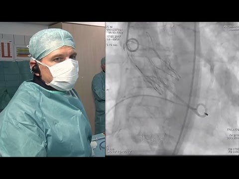 SYMETIS ACURATE neo™ TF TAVI system: unique self-expandable valve technology. EuroPCR 2017