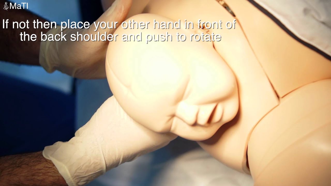 Shoulder Dystocia Delivery, Manoeuvres, Management, Simulation