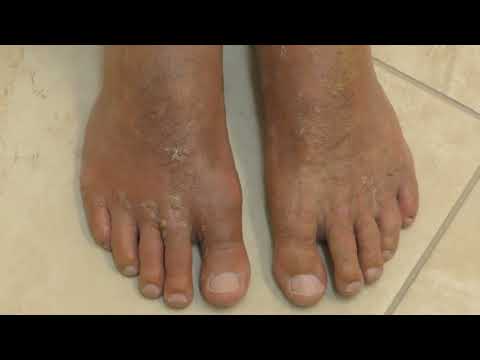 We see a skin allergic reaction by an anti-iflammatory gel and the treatment effect in 36 hours