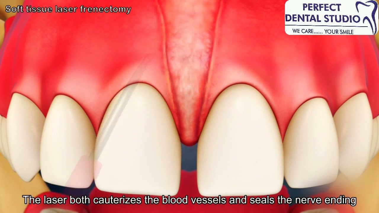 Soft tissue laser frenectomy