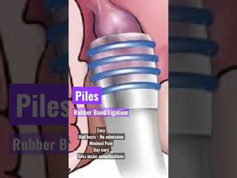 Rubber Band Ligation ~ Haemorrhoids Piles Bawasir - Most common Opd procedure for piles in USA