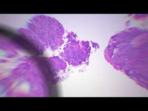 Ask a Pathologist: What is a Polyp?