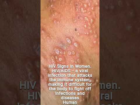 HIV/AIDS SIGNS AND SYMPTOMS IN WOMAN ???????????? https://youtu.be/ICPJcosSGTU