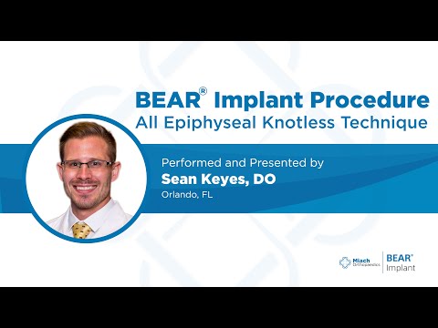 BEAR Implant Procedure | All Epiphyseal Knotless Technique | Miach Orthopaedics