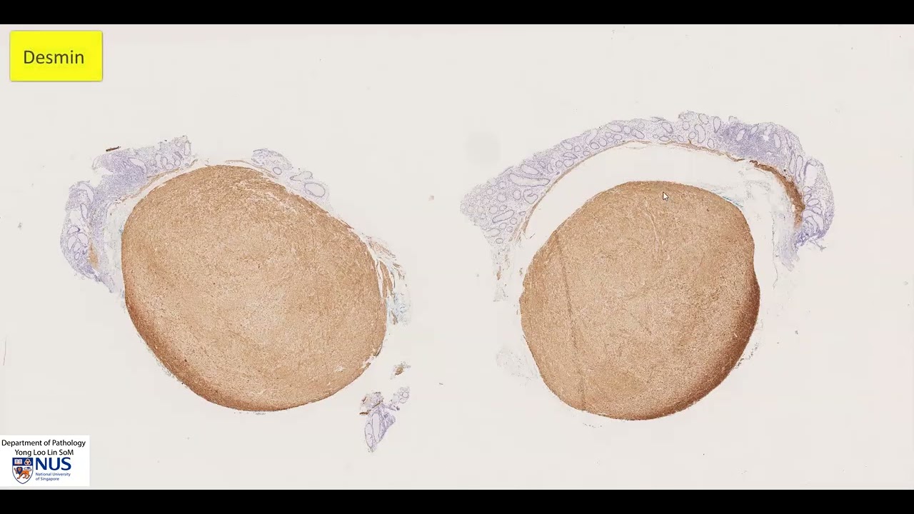 Colon: Leiomyoma Microscopy - Talking slide