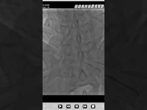 POST PTCA RO DISTAL RCA STENTING #shorts #angioplasty #trending
