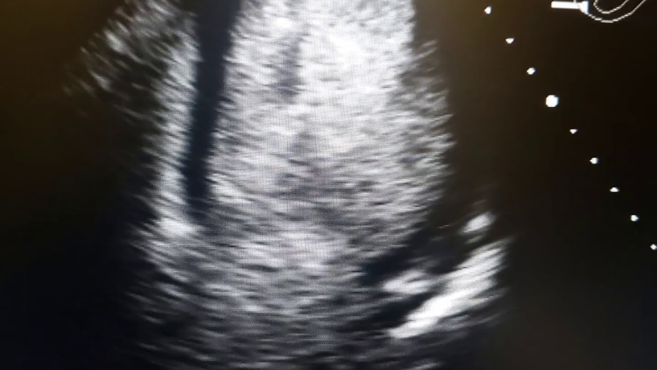 Contrast Echocardiogram to see LV walls