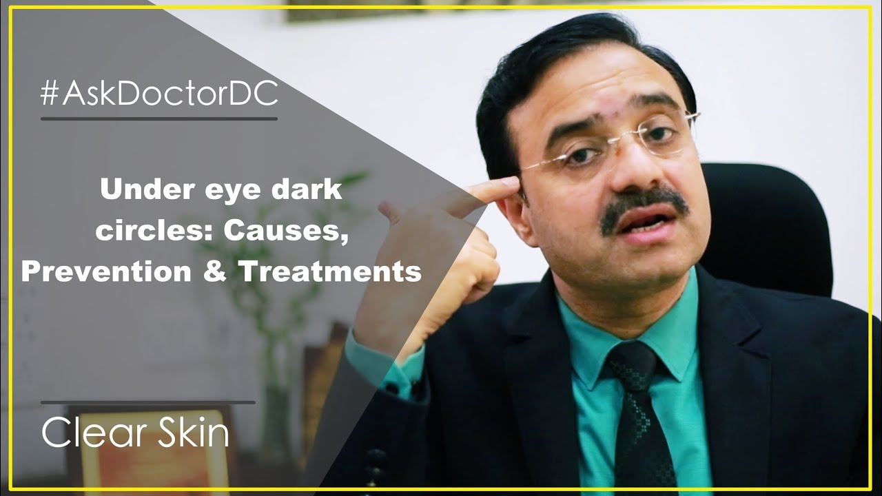 Under eye dark circles: Causes, Prevention & Treatments (English)