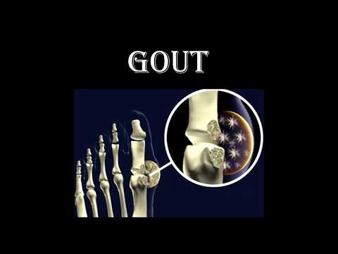 What Is Gout? The Silent Joint Attacker! #Gout #Arthritis #HealthFacts #JointPain #Shorts