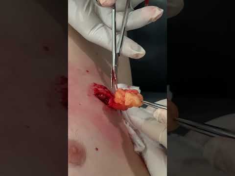 BIG STOMACH LIPOMA | PT 2
