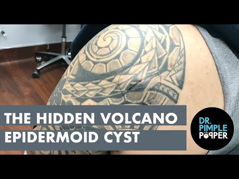 Dr. Pimple Popper Pops 'Tarantula' Cyst On Tattoo In Instagram Video