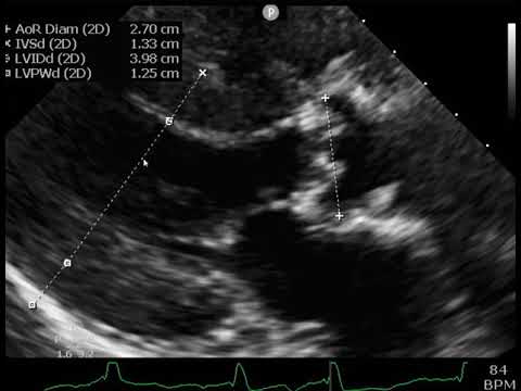 Difficulty in measuring LV thickness