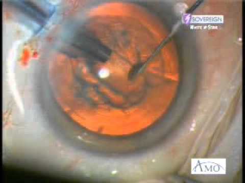 Cataract Surgery in Nuclear Sclerotic Cataract by Dr. Pradhan