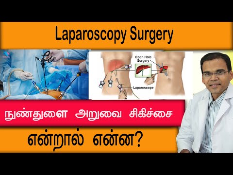 நுண்துளை அறுவைசிகிச்சை என்றால் என்ன? laparoscopy surgery treament