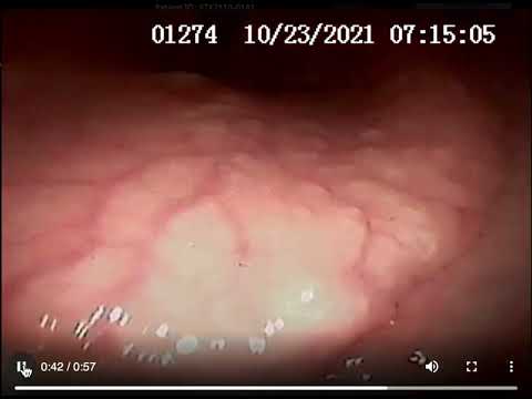 Chondritis moderate to severe