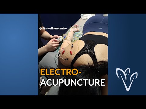 Electro-Acupuncture for Rotator Cuff Injuries - Massage Therapy | Vital Wellness Centre