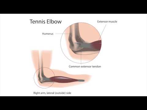 What is Tendinitis with Dr. Ron Short