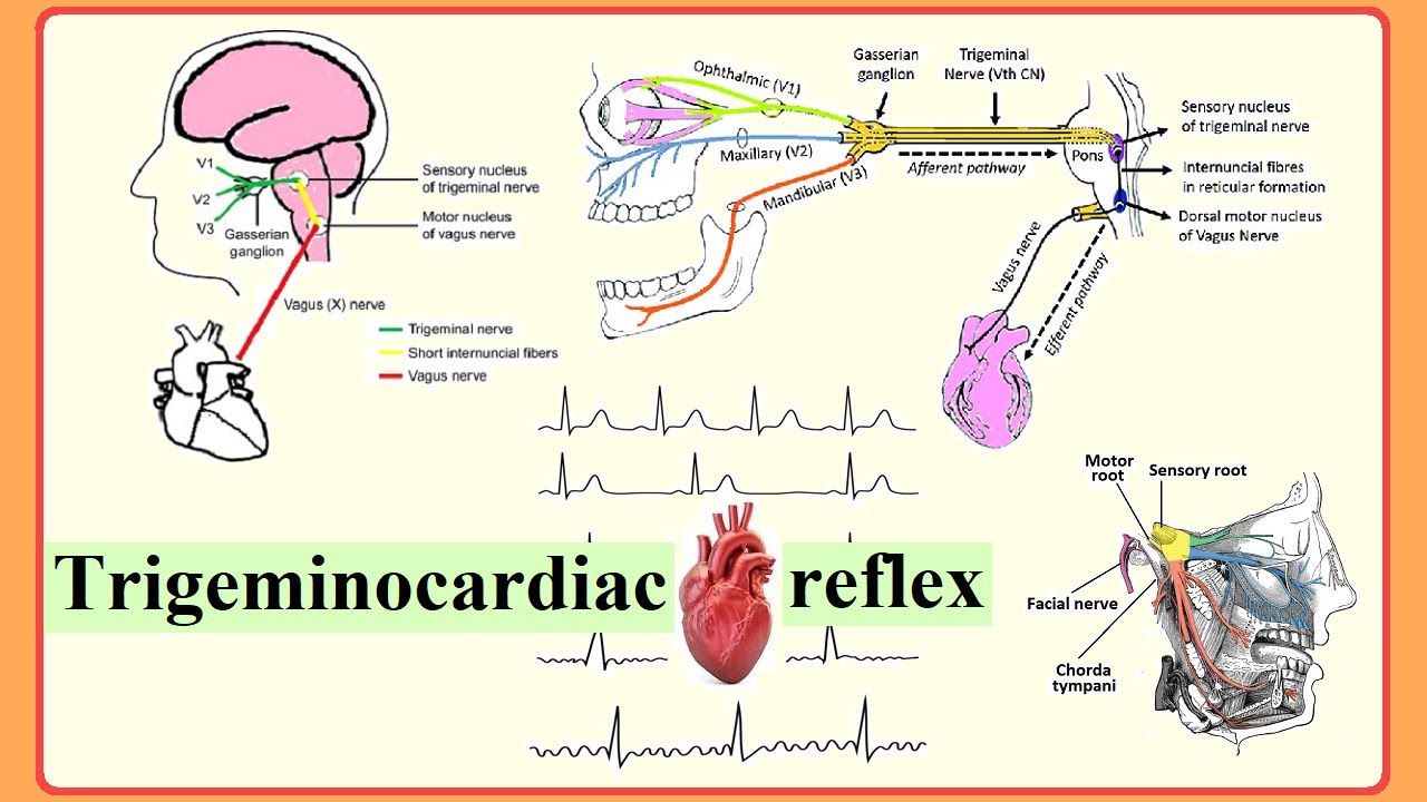 trigeminocardiac reflex