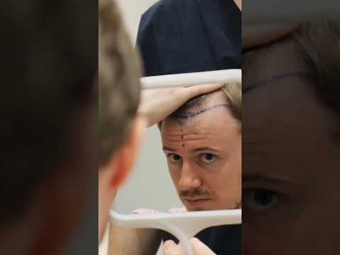 Flawlessly created hairline at Cosmedica Clinic #shorts #hairtransplant #cosmedicaclinic