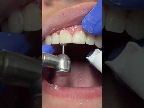 TAKING BRACES OFF🎉🎊 #reels #braces #bracesoff #orthodontist #shullmanorthodontics